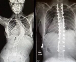 Spinal Surgery - South Florida Spinal Surgeon: Scoliosis, Complex ...