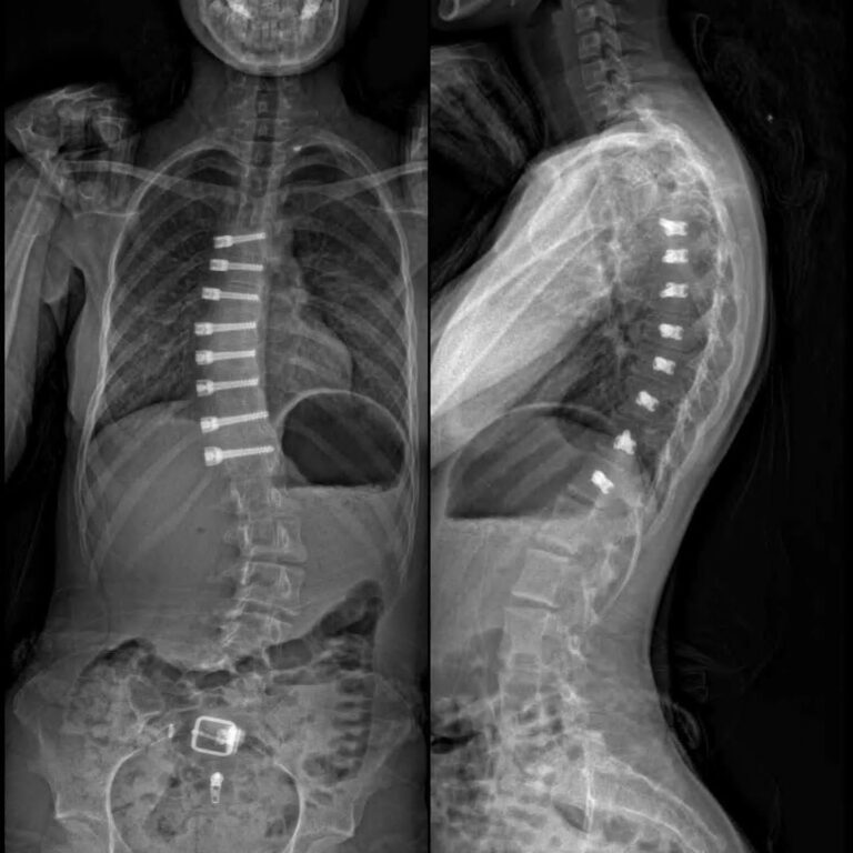 Spinal Tethering Surgery, Tethering Surgery For Scoliosis